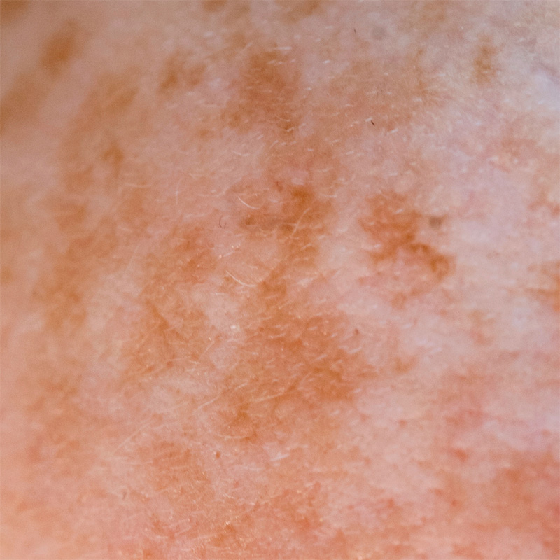 Startseite - Pure Skin Nina Hagedorn